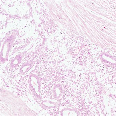 Photomicrograph Of The Umbilical Nodule Showing Endometrial Glands