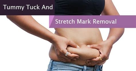 Can A Tummy Tuck Remove Stretch Marks On Hips Dr Asif Pirani