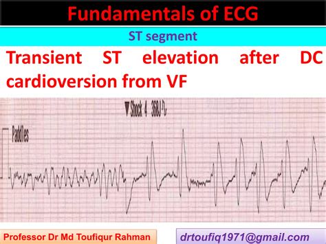 Approach To A Patient With St Segment Abnormality In Ecg Ppt