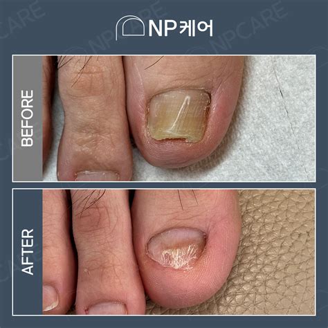 창원 진해 문제성발톱 창원 진해 내성발톱and발톱무좀 당신의 편안한 일상 Always Np케어 ⚠ 무료상담and예약문의 ⚠ Tel 010 5014 8125 🚕 창원시