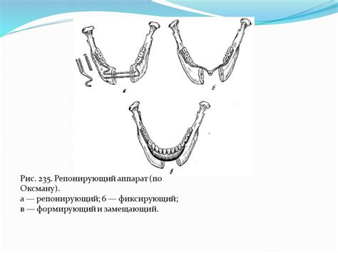 Механизм перелом челюсти