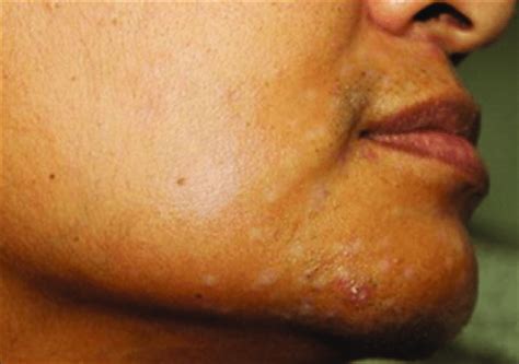Hypopigmentation On Face Polymorphic Light Eruption Multiple