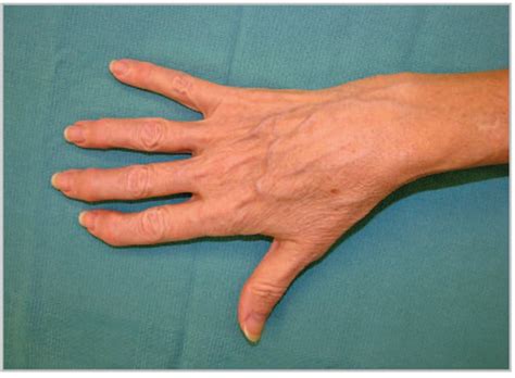 Distal Interphalangeal Joint