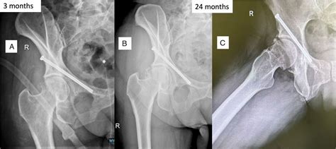 Impacted Fracture Femur