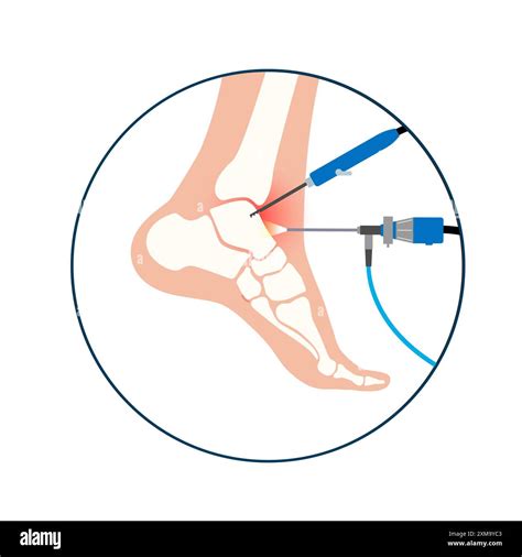 Illustration Of An Ankle Arthroscopy Procedure This Is A Procedure For Diagnosing And Treating