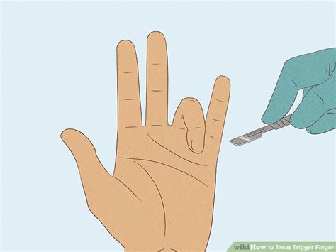 How To Treat Trigger Finger 8 Steps With Pictures WikiHow
