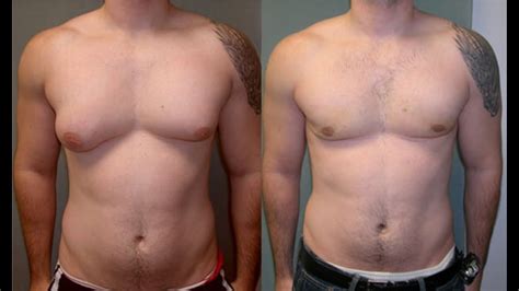 How To Know If You Have Gynecomastia Or Fat Youtube