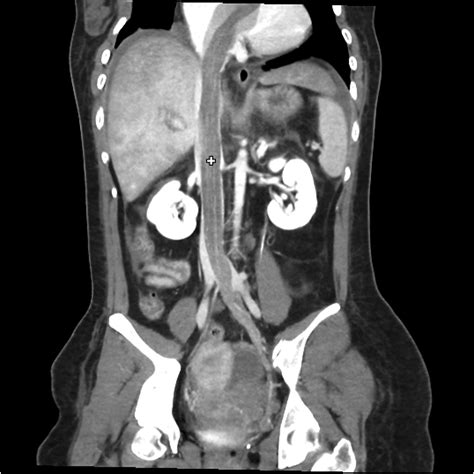 Mass In The Inferior Vena Cava Journal Of Emergency Medicine
