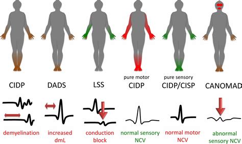 Chronic Inflammatory Demyelinating Polyneuropathy Update On Diagnosis Immunopathogenesis And