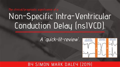 Non Specific Intra Ventricular Conduction Delay A Quick Lit Review