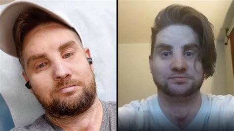Face Transplant Before And After