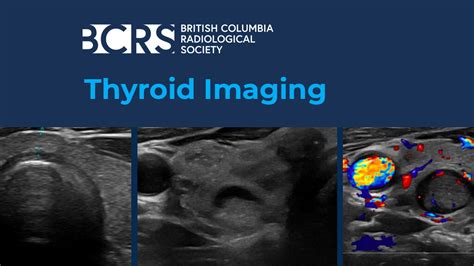 Thyroid Imaging 2023 British Columbia Radiological Society