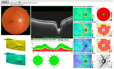 Oct Imaging 26 January 2022 Demonstrating Persistent Loss Of The Download Scientific Diagram