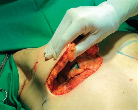 Further Parenchyma Resection May Be Necessary So The Remaining Breast Download Scientific