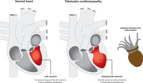 Takotsubo Cardiomyopathy Heart Conditions Heart Foundation Nz