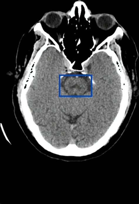 Atrophie Cortico Sous Corticale Débutante Et Plage Hypodense Centro Pontique Compatible Avec Une