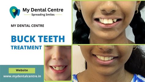 Buck Teeth Treatment Buck Teeth Treatment Cost In India