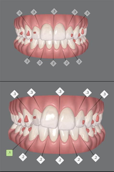 Ipr Can Someone Explain This To Me Rinvisalign