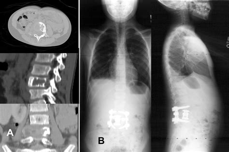 Aneurysmal Bone Cyst Spine