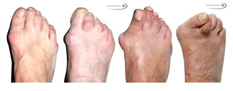 Hallux Valgus The Ganglion On The Big Toe Conservative Treatment Or