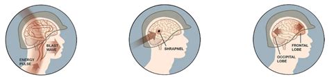 Blast Tbi Horizon Tbi And Brain Center