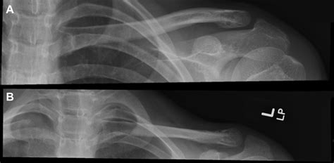 Distal Clavicle Fixation With Nonabsorbable Suture In A Pediatric