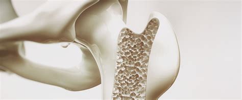 Osteoporosis Osteosmart