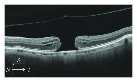 Optical Coherence Tomography Of Full Thickness Macular Holes A With