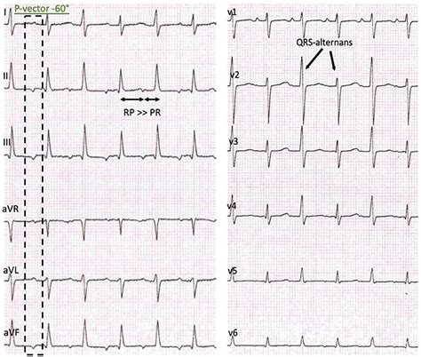 Atrial Rhythm