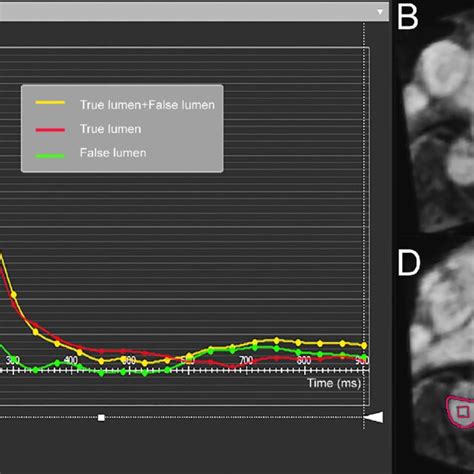 Quantitative Flow Evaluation Of True Lumen And False Lumen Using