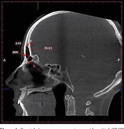 Figure 1 From Reliability Of The Frontal Sinus Index For Sex Determination Using Cbct Semantic