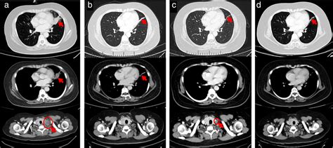 Subsequent Chest Ct Scans A Patients Ct Scan At Diagnosis B Download Scientific Diagram