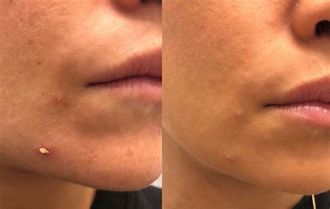 How To Hide Red Spots On Face Without Makeup Saubhaya Makeup