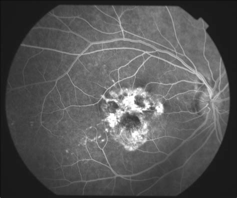Case 6 Choroidal Neovascularization Without Photodynamic Therapy Download Scientific Diagram