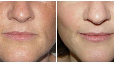 Pico Genesis Revive At The Group Med Spa Pico Genesis Revive At The Group Med Spa