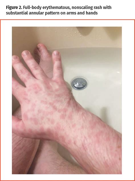 Maculopapular Rash Syphilis