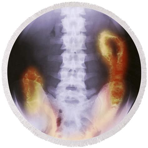 Spinal Cord Ulcerative Colitis X Ray Art Print By Science Source