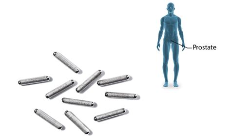 Prostate Seed Brachytherapy Else Solutions