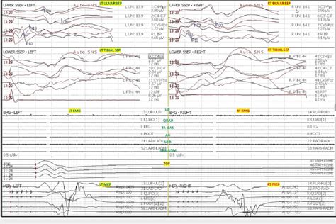 Multimodality Intraoperative Neurophysiological Monitoring Ionm Download Scientific Diagram