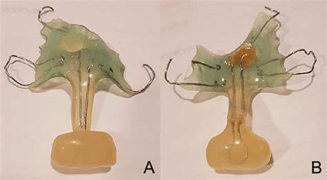 Upper And Lower View Of The Speech Bulb Used During The Intensive
