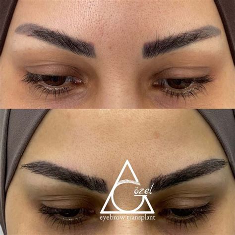 Eyebrow Transplant Surgery Results Risks Cost