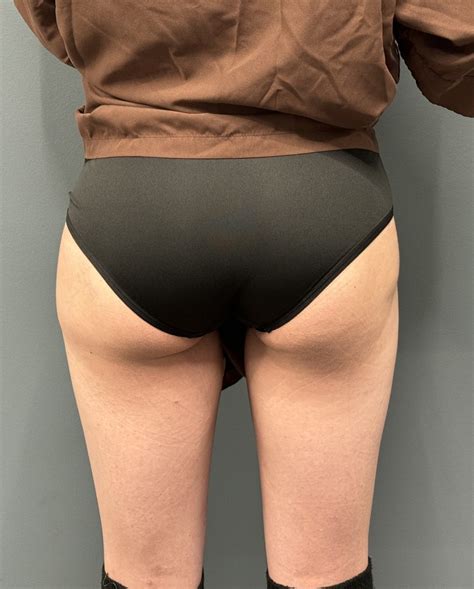Plastic Surgery Case Study Custom Hip Implants For Hip Dips Explore