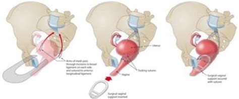 Surgical Technique For Mesh Hysteropexy A U Shaped Mesh Passes Download Scientific Diagram