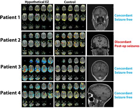 Simultaneous Intracranial Electrical Stimulation And Fmri Seeg Fmri For Improved Post