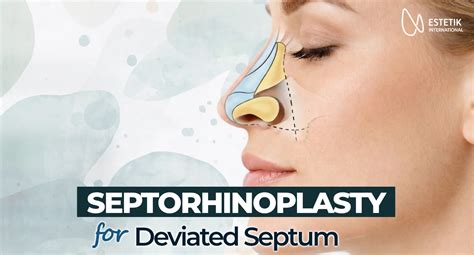 Septorhinoplasty Guide Costs Recovery And Turkey Estetik International