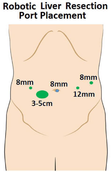 Robotic Liver Resection Port Placement Download Scientific Diagram