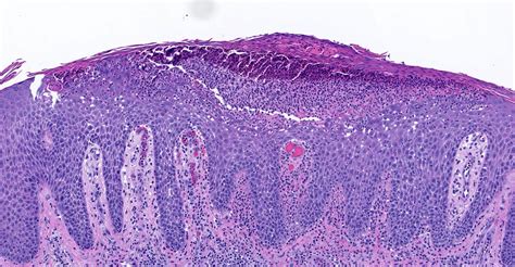 Plaque Psoriasis Pathology Outlines At Josh Pitre Blog