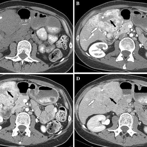 Patient 3 With Hcc Chevron In Hepatic Segments 2 And 3 A Download Scientific Diagram
