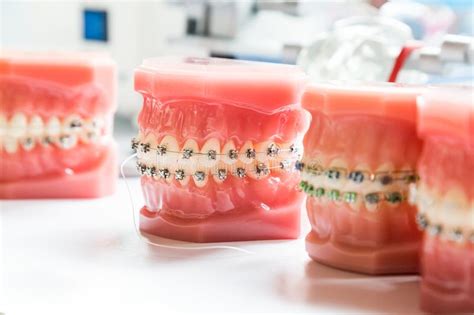 Braces Color Selector For Girls