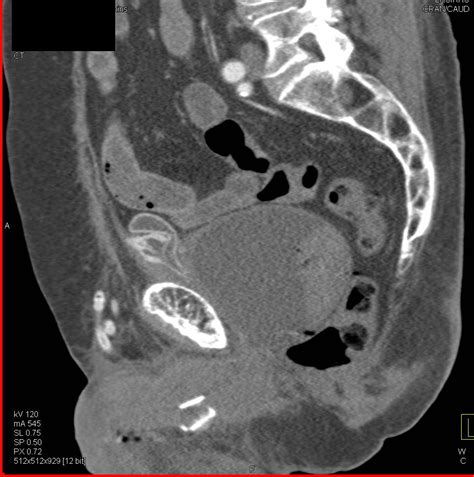 Normal Bladder Genitourinary Radiology Case Studies Ctisus Ct Scanning